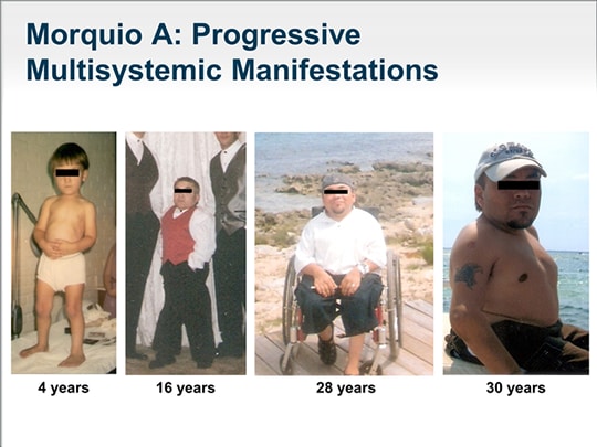 Diagnosis And Treatment Of Morquio A Syndrome Expert Perspectives Transcript