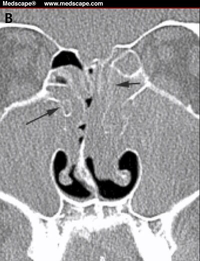 Nasal Polyps Ct