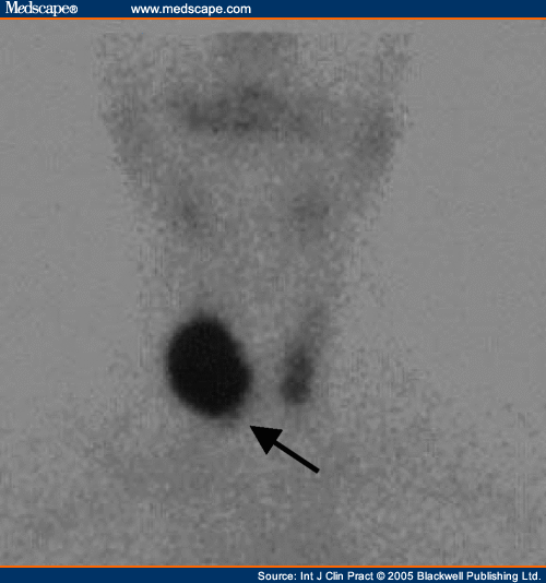 Hot Thyroid Nodule