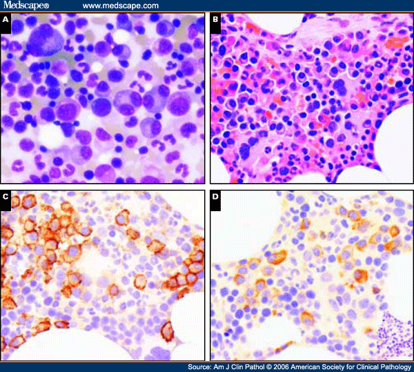 Bone Marrow Biopsy Multiple Myeloma Histology Slides - vrogue.co Bone Marrow Biopsy Multiple Myeloma Histology Slides - vrogue.co