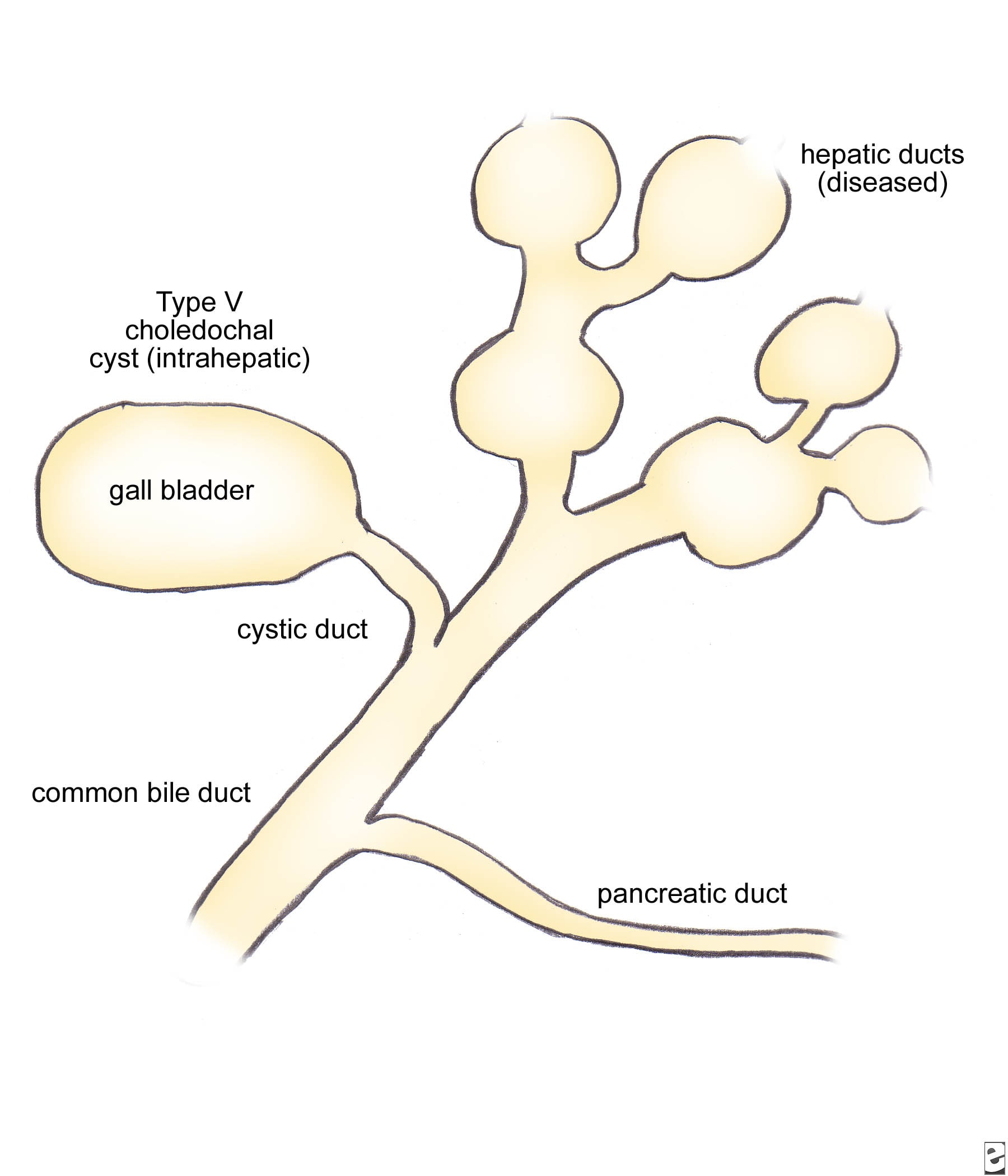 Choledochal Cyst Congenital Choledochal Cyst Choledochal Cyst Type I Common Bile Duct Cyst