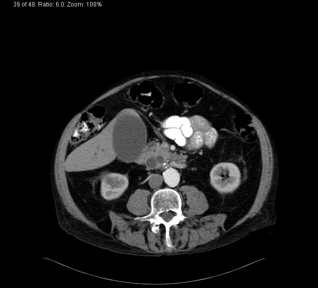 Difference Between Ampulla Of Vater And Sphincter Of Oddi Diet