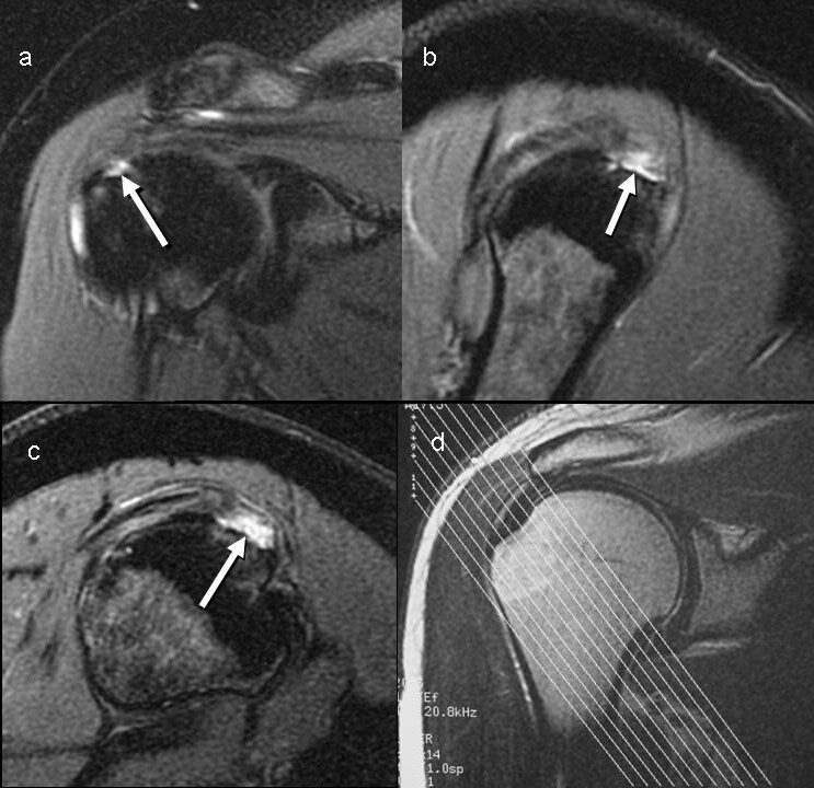 Rotator Cuff Tears MRI 