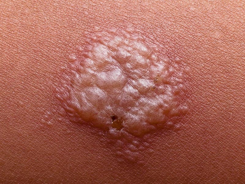 Latent TB Shorter Course Of Therapy Effective In Children