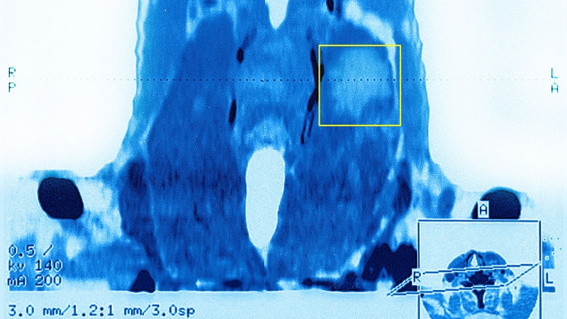 Ultrasoundguided Thyroid Nodule Biopsy Offers Rapid Ultrasoundguided Thyroid Nodule Biopsy Offers Rapid