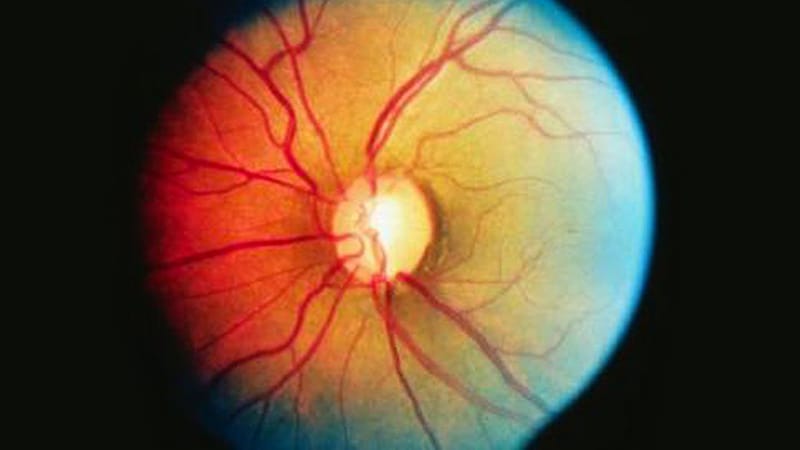 Glaucoma Cataract Surgery The Istent Procedure Eye