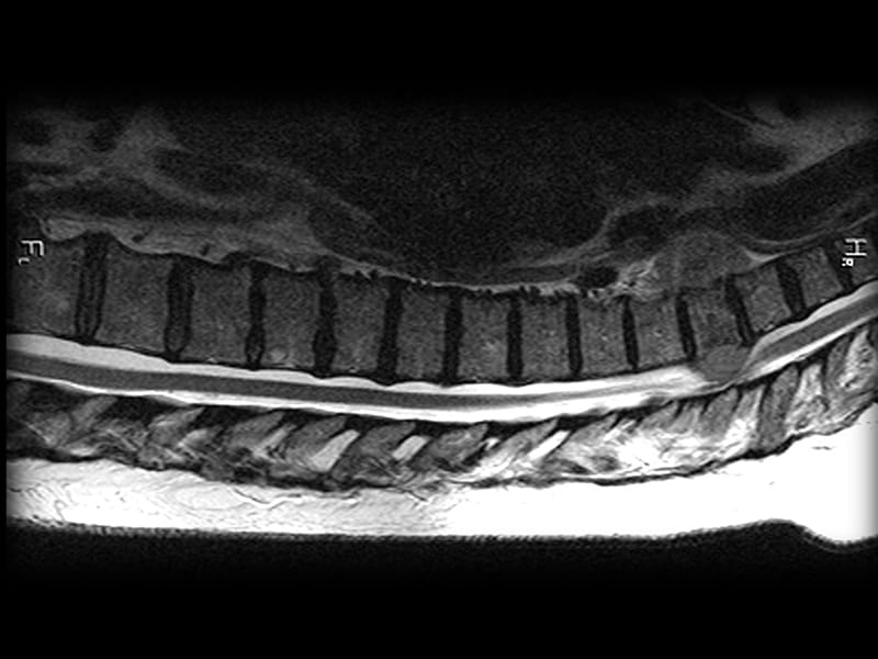 One RT Dose Enough For Metastatic Spinal Cord Compression one-rt-dose-enough-for-metastatic-spinal-cord-compression